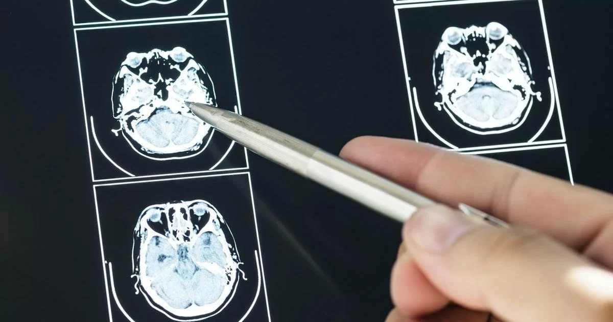 Meningiom cerebral - Dr. Ștefan Mindea