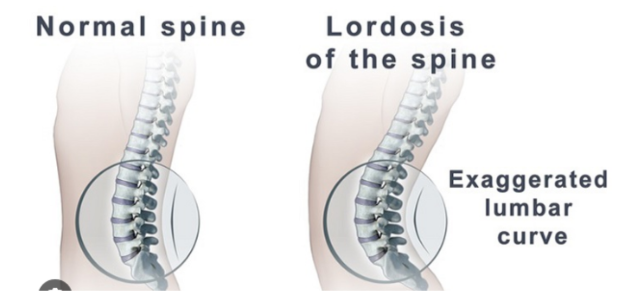 Ce este lordoza? - Dr. Mindea