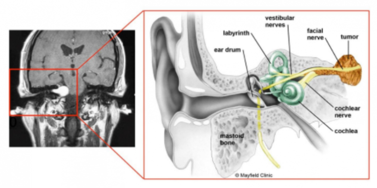 Totul despre neurinomul acustic sau schwanom vestibular - Mindea